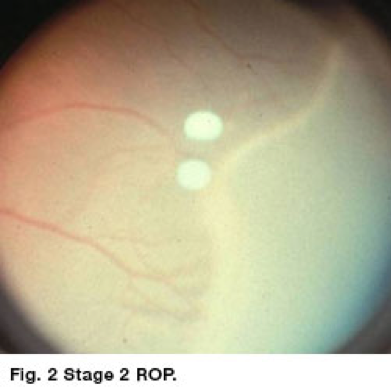 Retinopathy of Prematurity - Eyes 4 Kids
